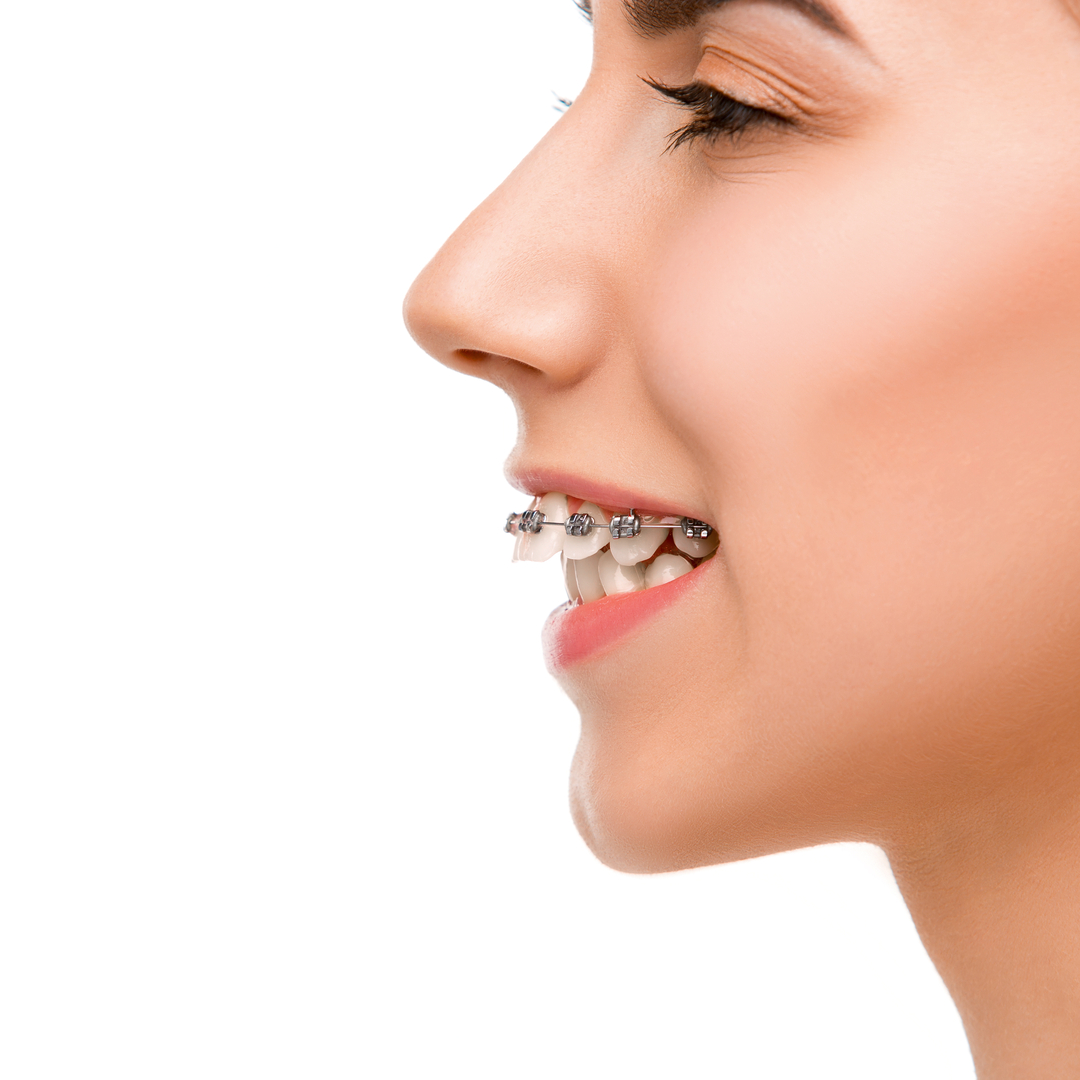 Overbite in Escondido, CA | Kidz Care Dental Group
